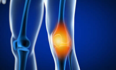 Hyaluronic gel injections for knee arthritis - Arthritis and ...