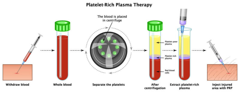 Platelet Rich Plasma (PRP) anti-aging knee arthritis therapy (Regenerative therapy) - Arthritis ...